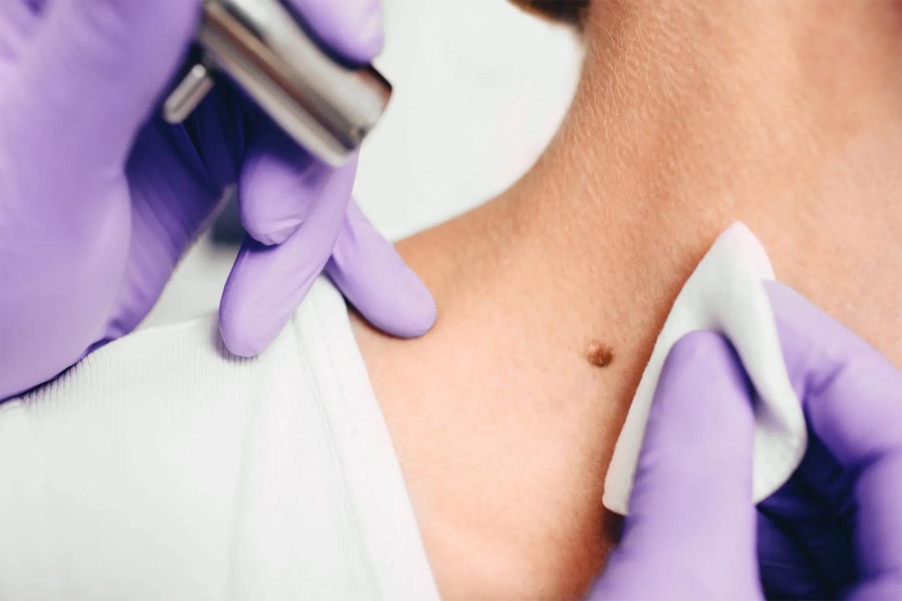 Skin Examinations - Skin Cancer North GA